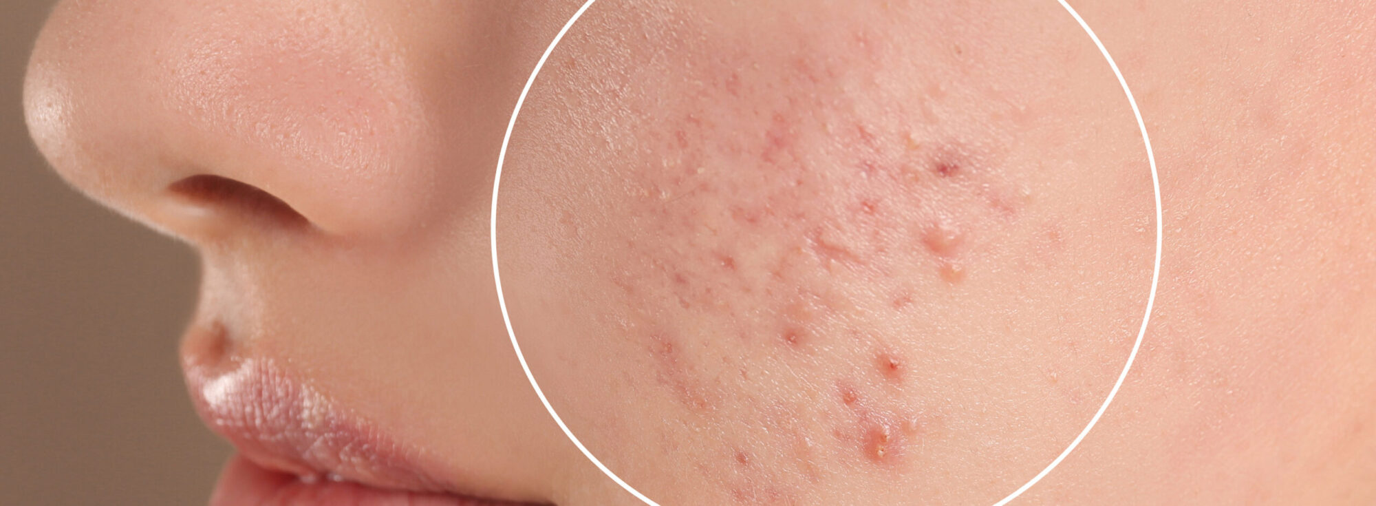 Unveiling the Science-Powered Solution for Clearer Skin - Nexus Pharma